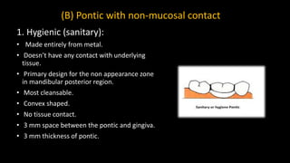 bridge and pontic design lecture | PDF