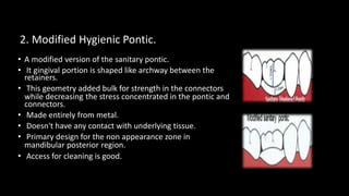 bridge and pontic design lecture | PDF