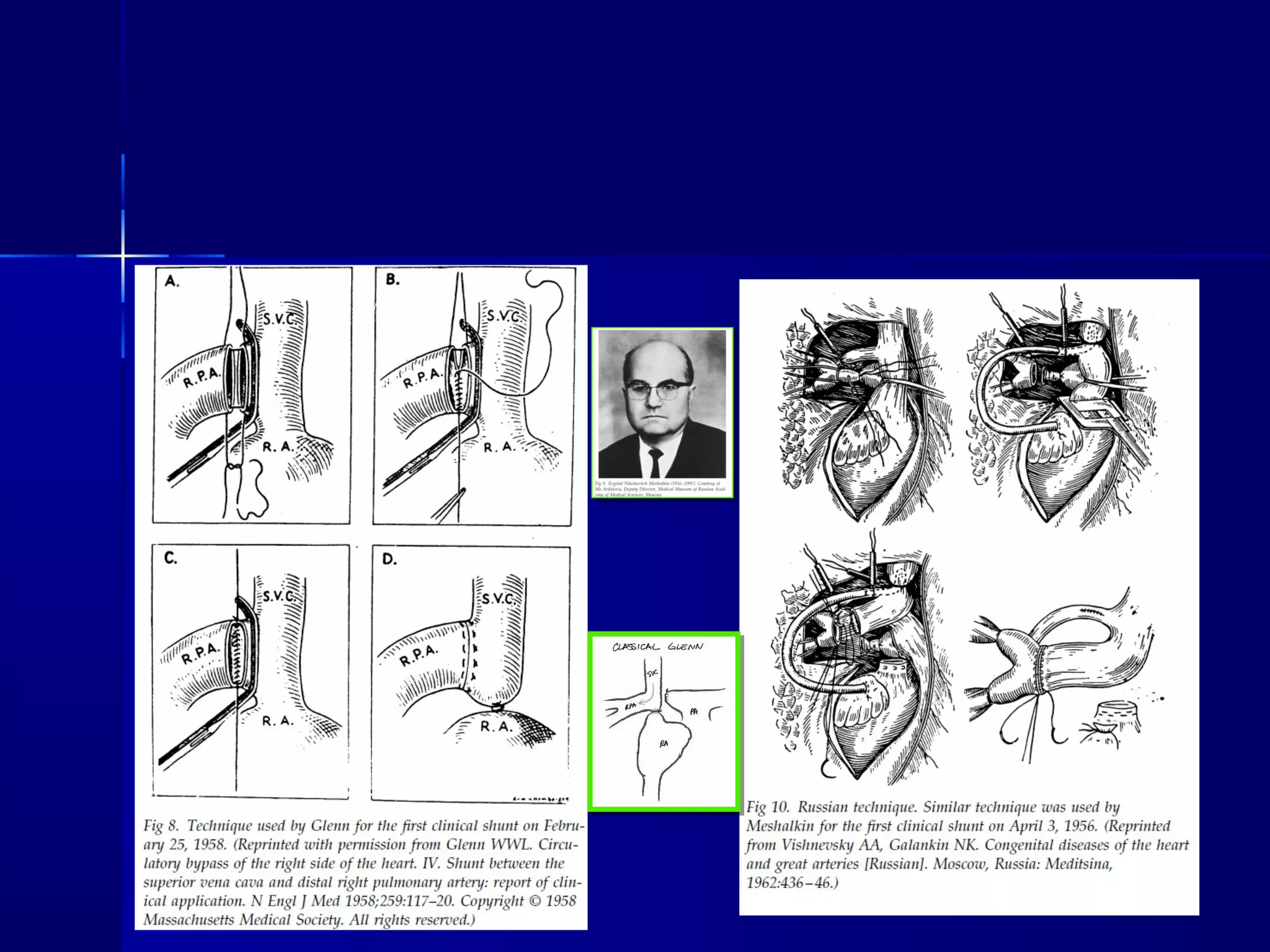 Novel fenestration designs for controlled venous flow shunting in ...