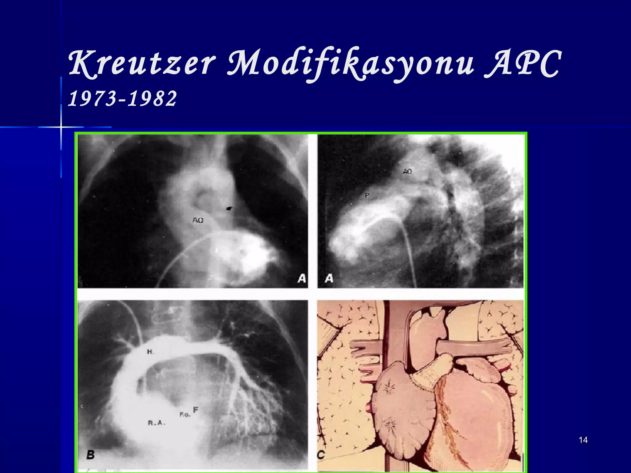 Novel fenestration designs for controlled venous flow shunting in ...