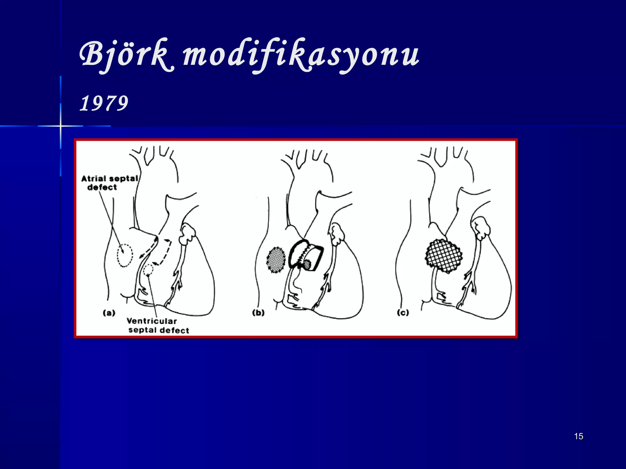 Novel fenestration designs for controlled venous flow shunting in ...
