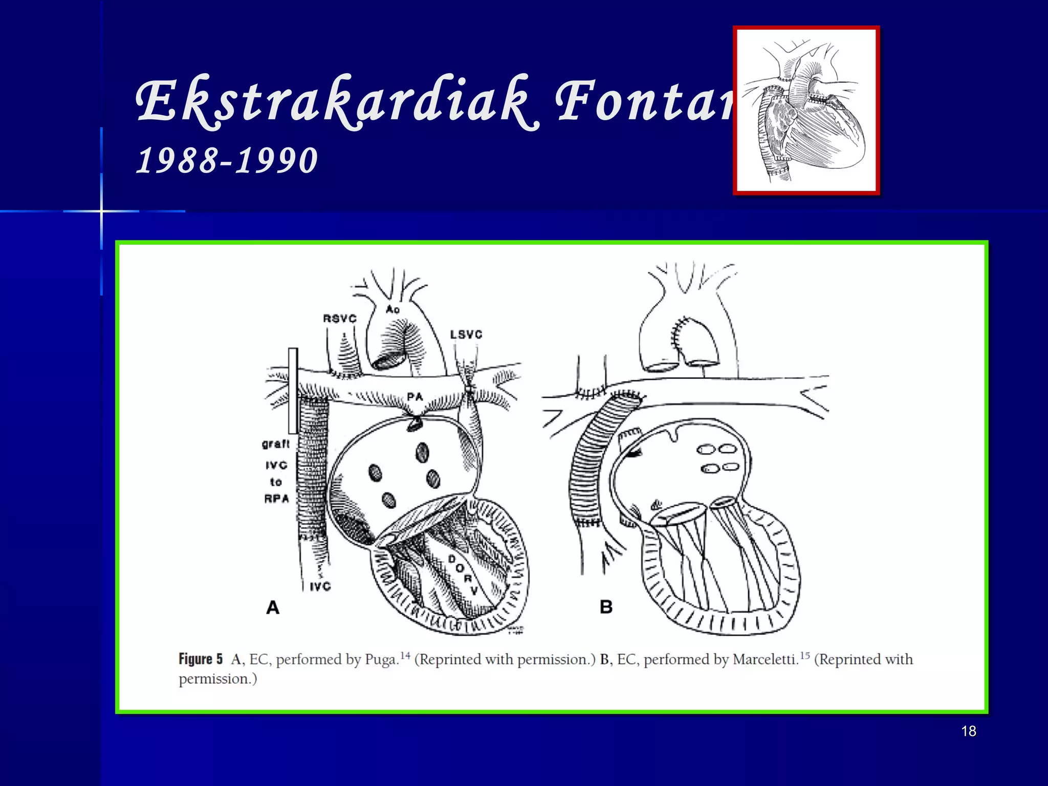 Novel fenestration designs for controlled venous flow shunting in ...