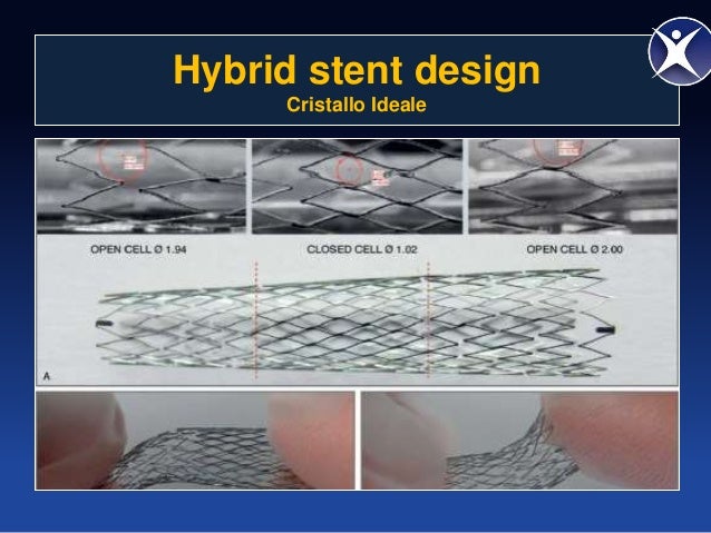 Novel self expanding nitinol carotid stent - dr Krzysztof Milewski