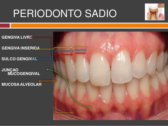 Periodontia em Odontologia