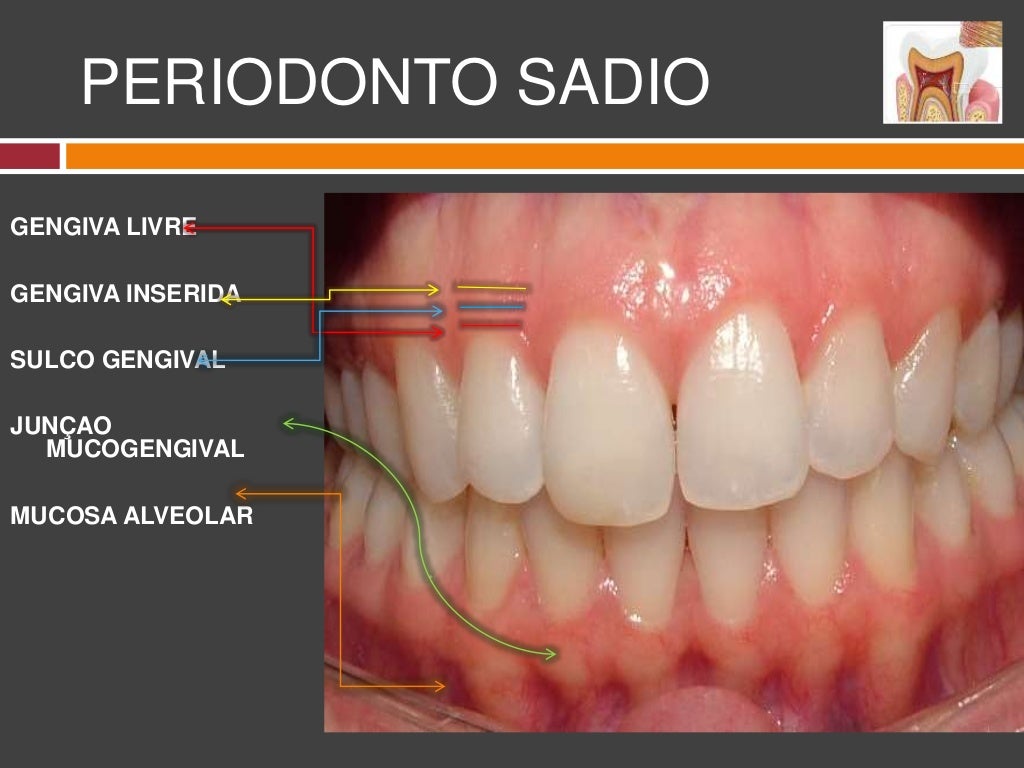 Periodontia em Odontologia