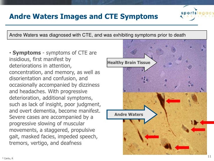 Chris Nowinski Presentation on Brain Injuries at Independent Summit