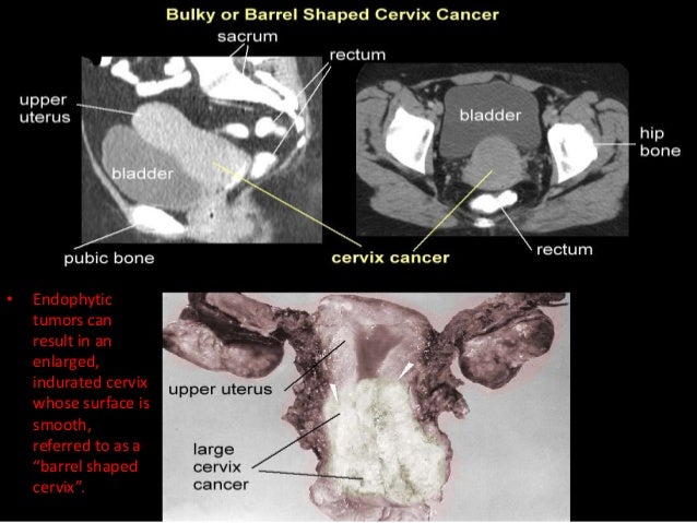 Cervical Cancer