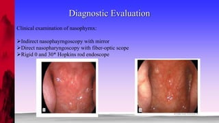 NASOPHARYNGEAL CARCINOMA | PPTX