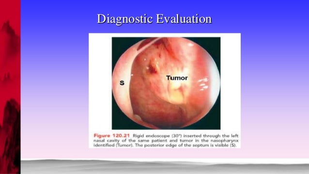 NASOPHARYNGEAL CARCINOMA