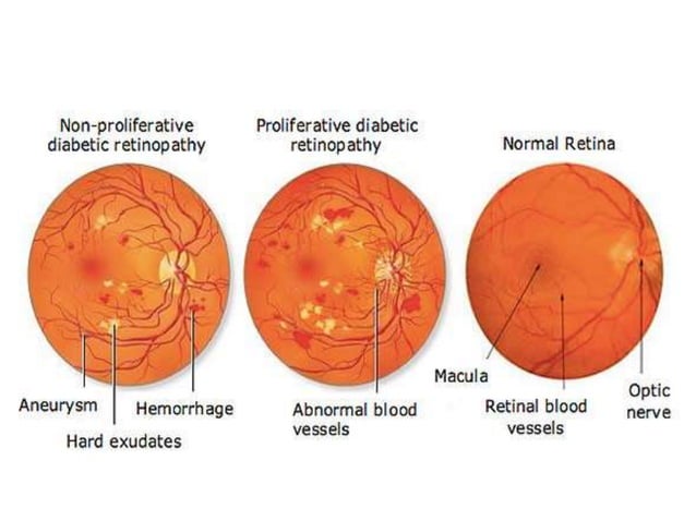 Non Proliferative Diabetic Retinopathy | PPTX | Diabetes | Diseases and ...