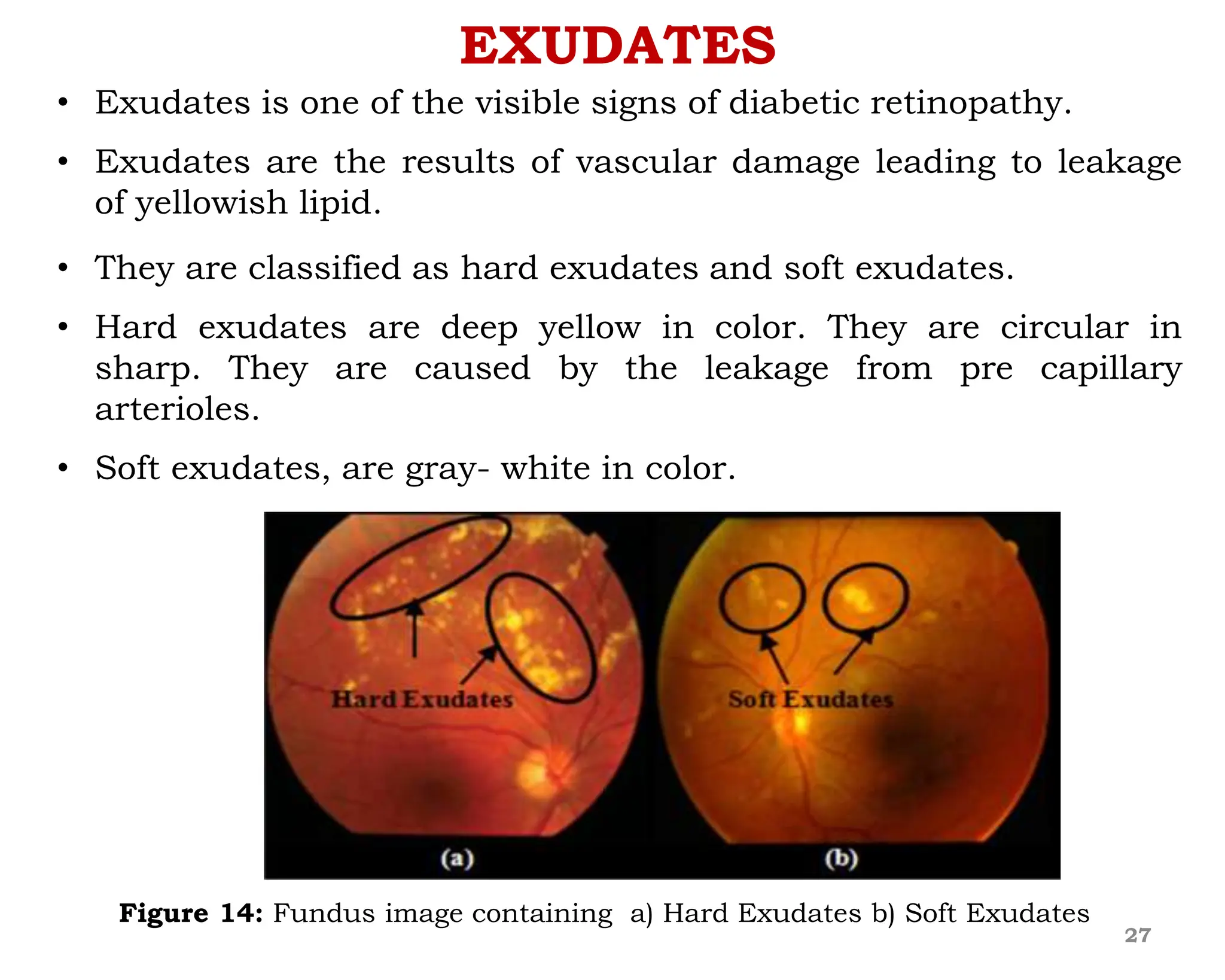 DIABETIC RETINOPATHY FROM FUNDUS IMAGES_VIVA VOCE_MSA.pptx