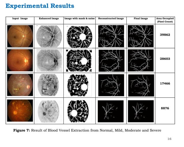 DIABETIC RETINOPATHY FROM FUNDUS IMAGES_VIVA VOCE_MSA.pptx