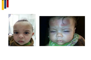 non-epileptic paroxysmal events in childern | PDF