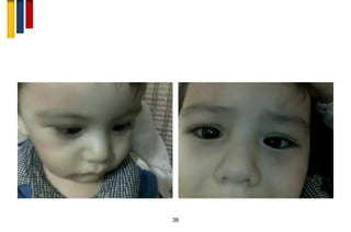 non-epileptic paroxysmal events in childern | PDF