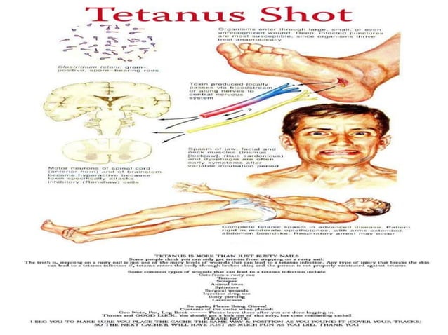 Tetanus | PPTX