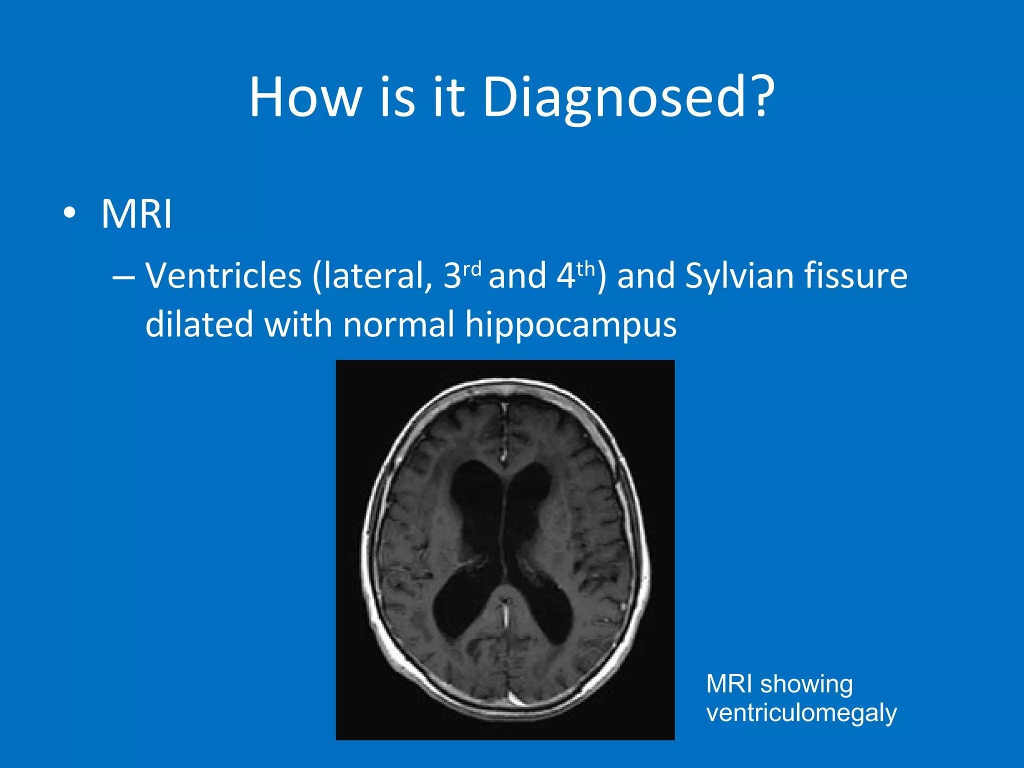 Normal Pressure Hydrocephalus | PPT