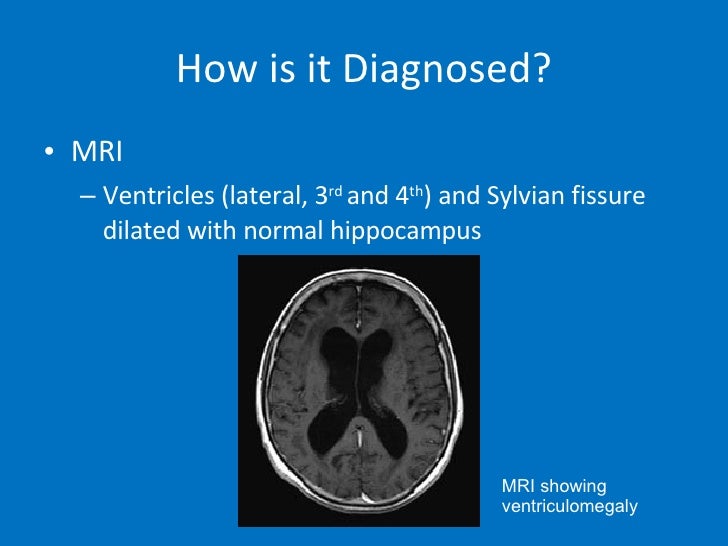 Normal Pressure Hydrocephalus