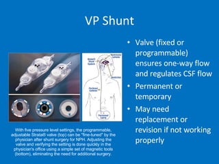 Normal Pressure Hydrocephalus | PPT