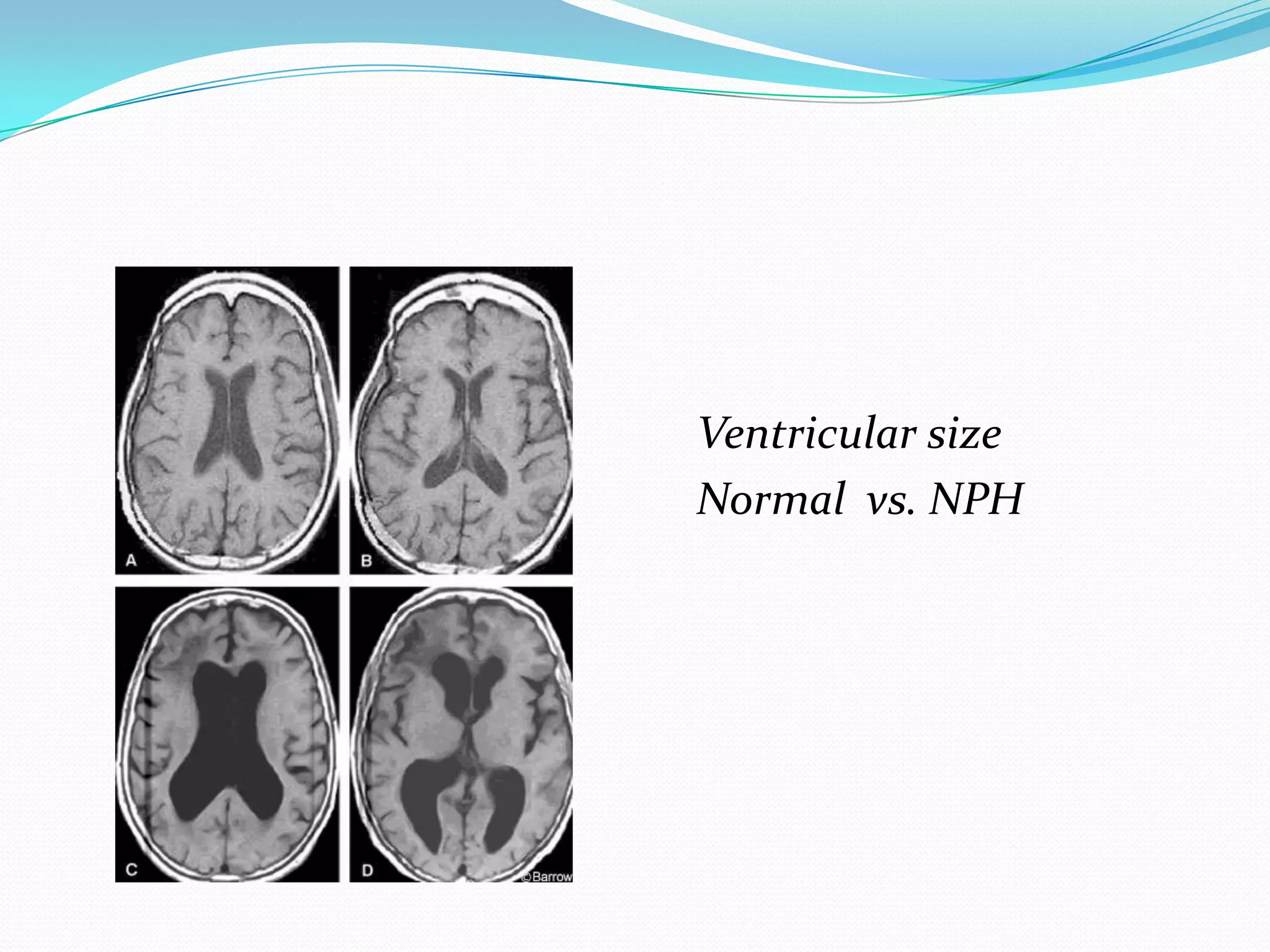 Normal Pressure Hydrocephalus | PPSX