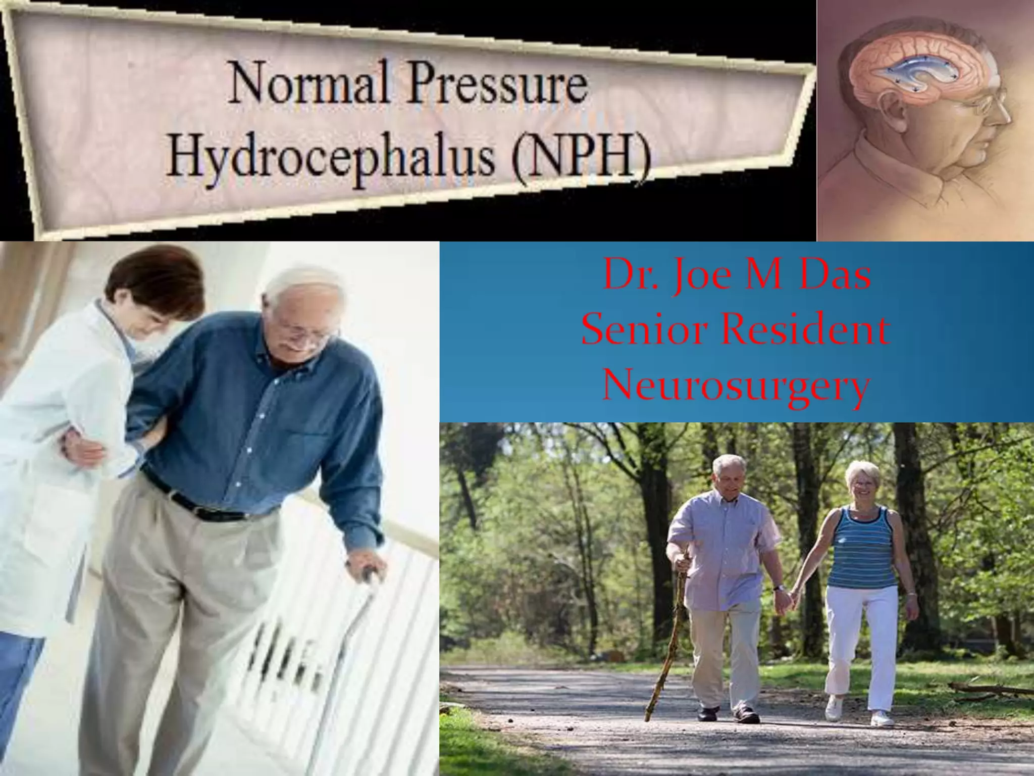 Normal Pressure Hydrocephalus | PPSX