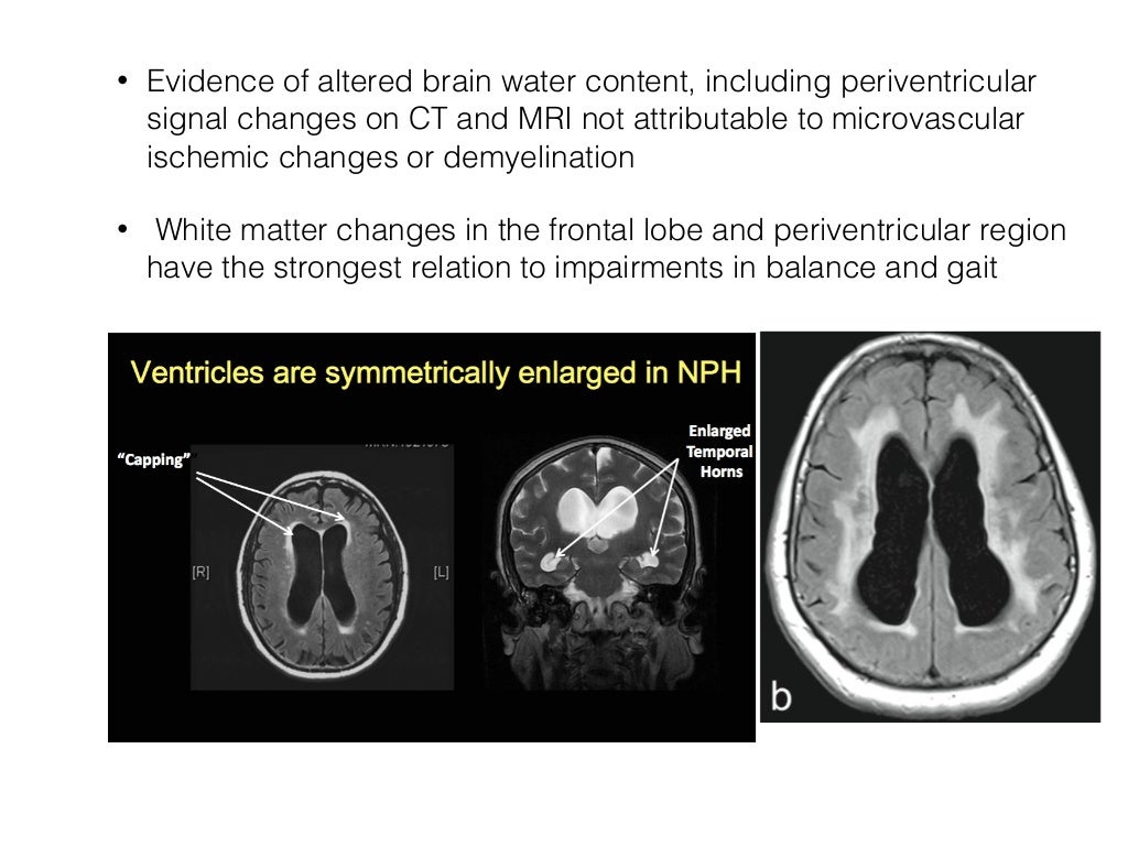 Surgical management of NPH