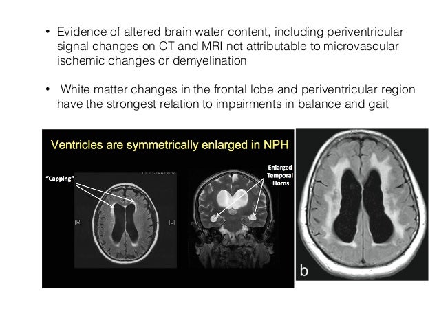 Surgical management of NPH