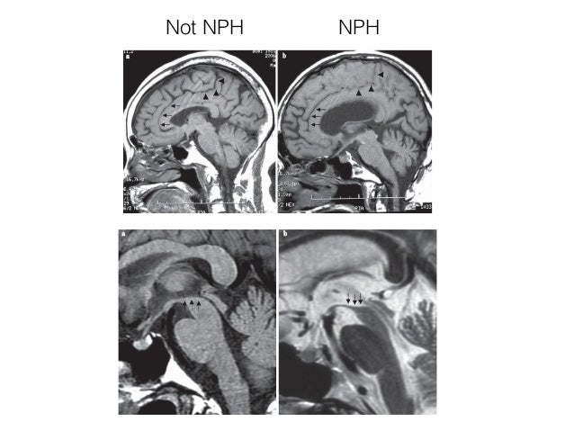 Surgical management of NPH
