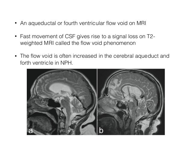 Surgical management of NPH