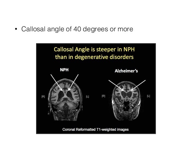 Surgical management of NPH