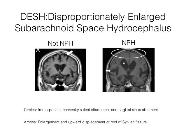 Surgical management of NPH