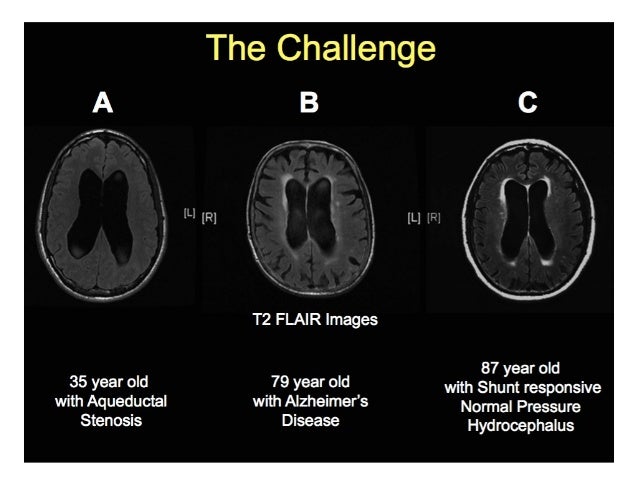 Surgical management of NPH