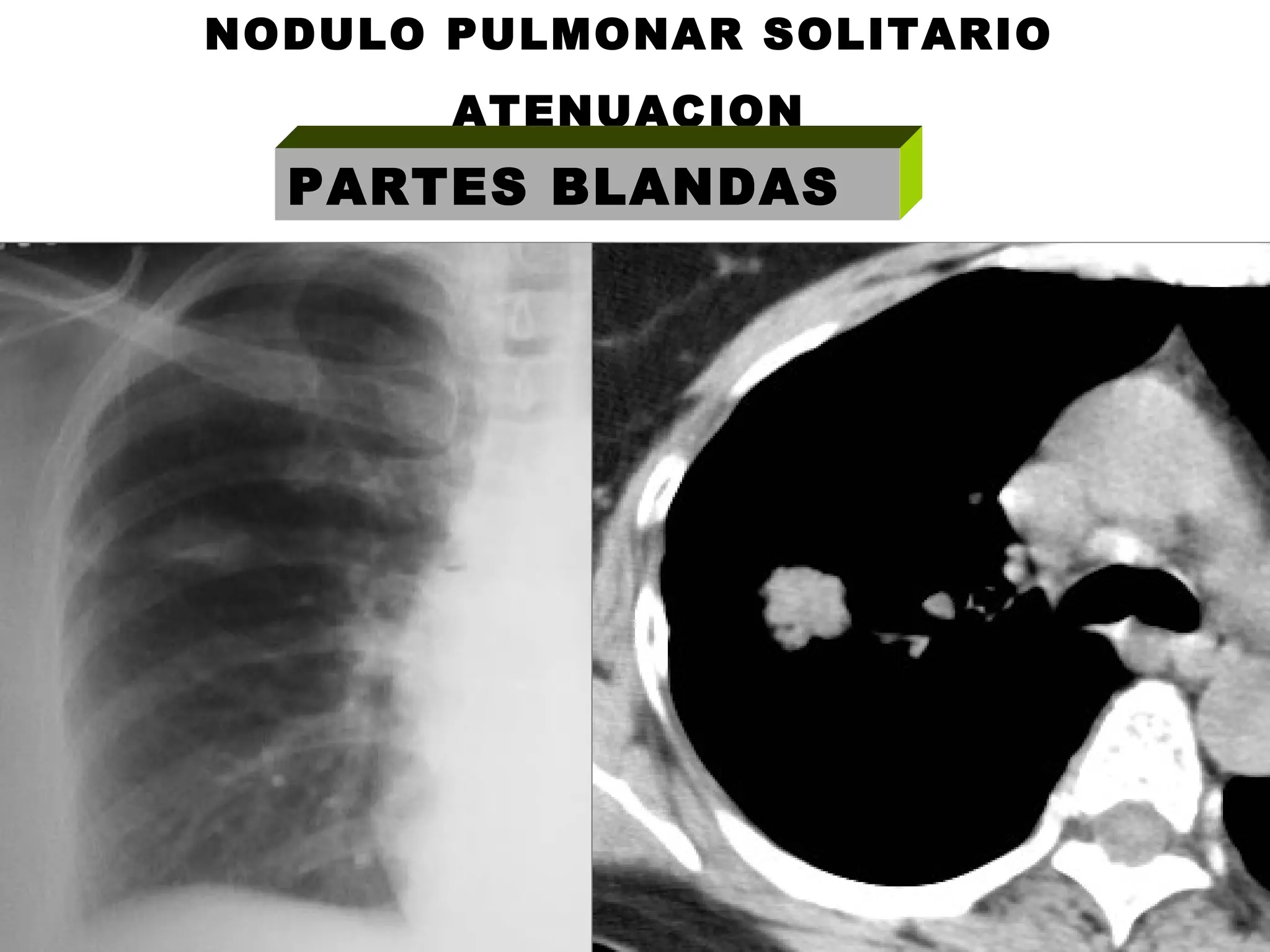 Nodulo Pulmonar Solitario - Dg. Imagen - Barcelo 2015 | PPT