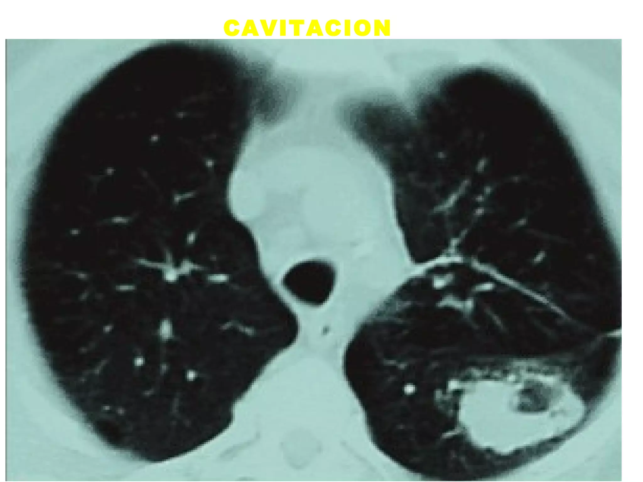 Nodulo Pulmonar Solitario - Dg. Imagen - Barcelo 2015 | PPT