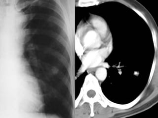 Nodulo Pulmonar Solitario - Dg. Imagen - Barcelo 2015 | PPT