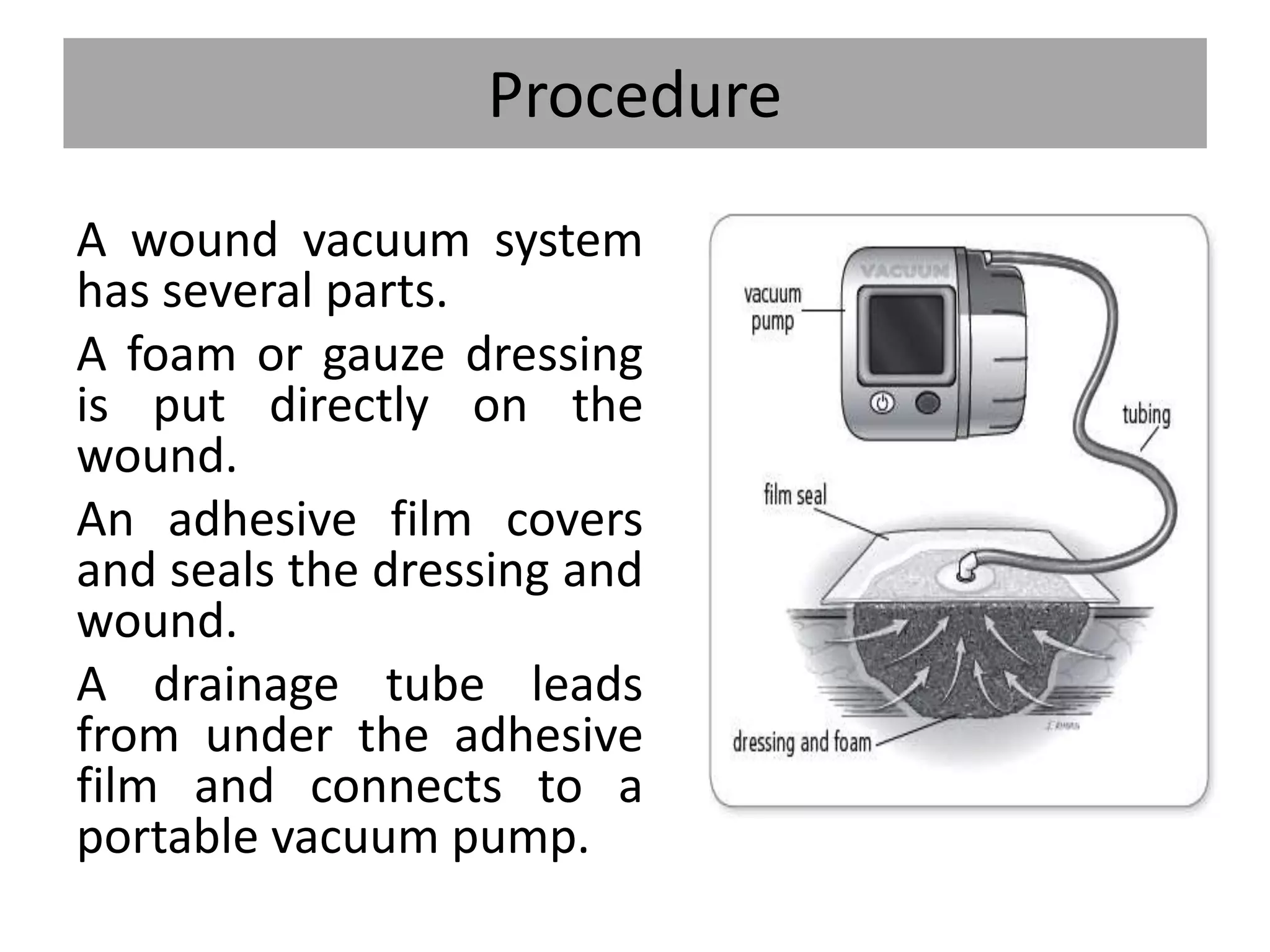 Update on negative pressure wound therapy for venous leg ulcer | PPTX