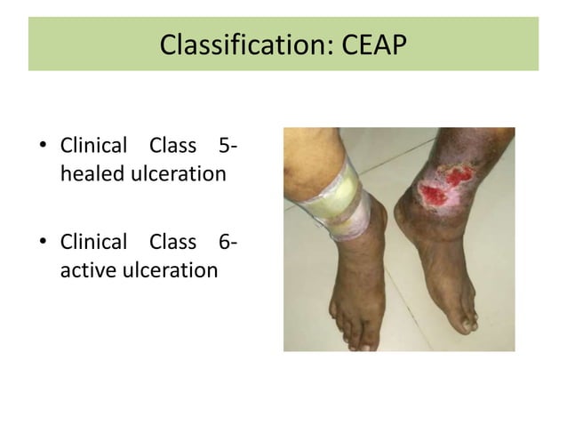 Update on negative pressure wound therapy for venous leg ulcer | PPT
