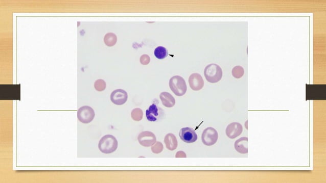 NRBC - Nucleated Red Blood Cells | PPTX | Blood Disorders | Diseases ...