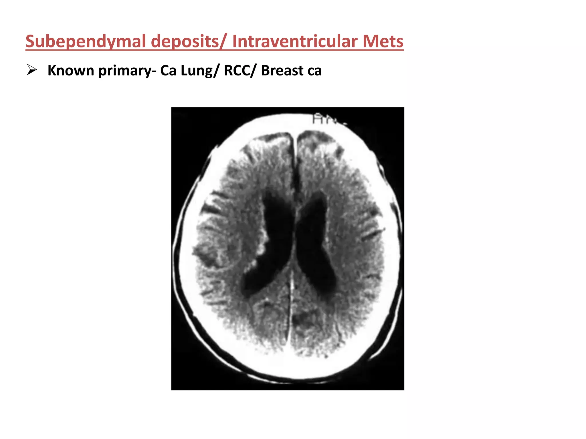 NRC intraventricular sol.pptx