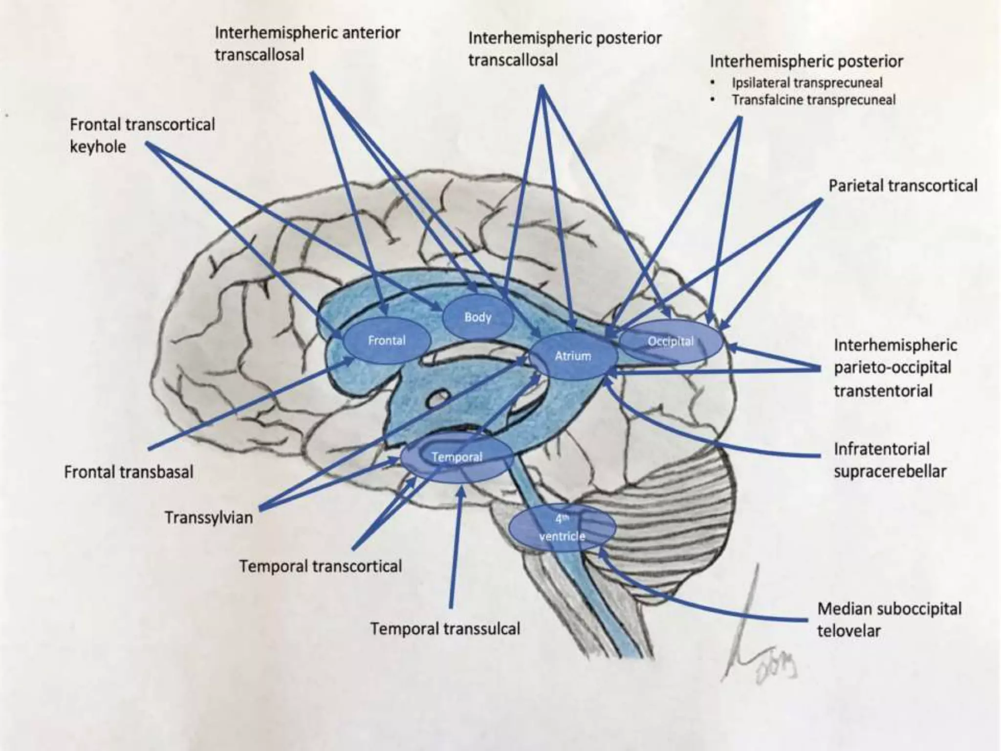 NRC intraventricular sol.pptx