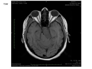 petroclival meningioma chordoma | PPTX | Brain and Nervous System ...