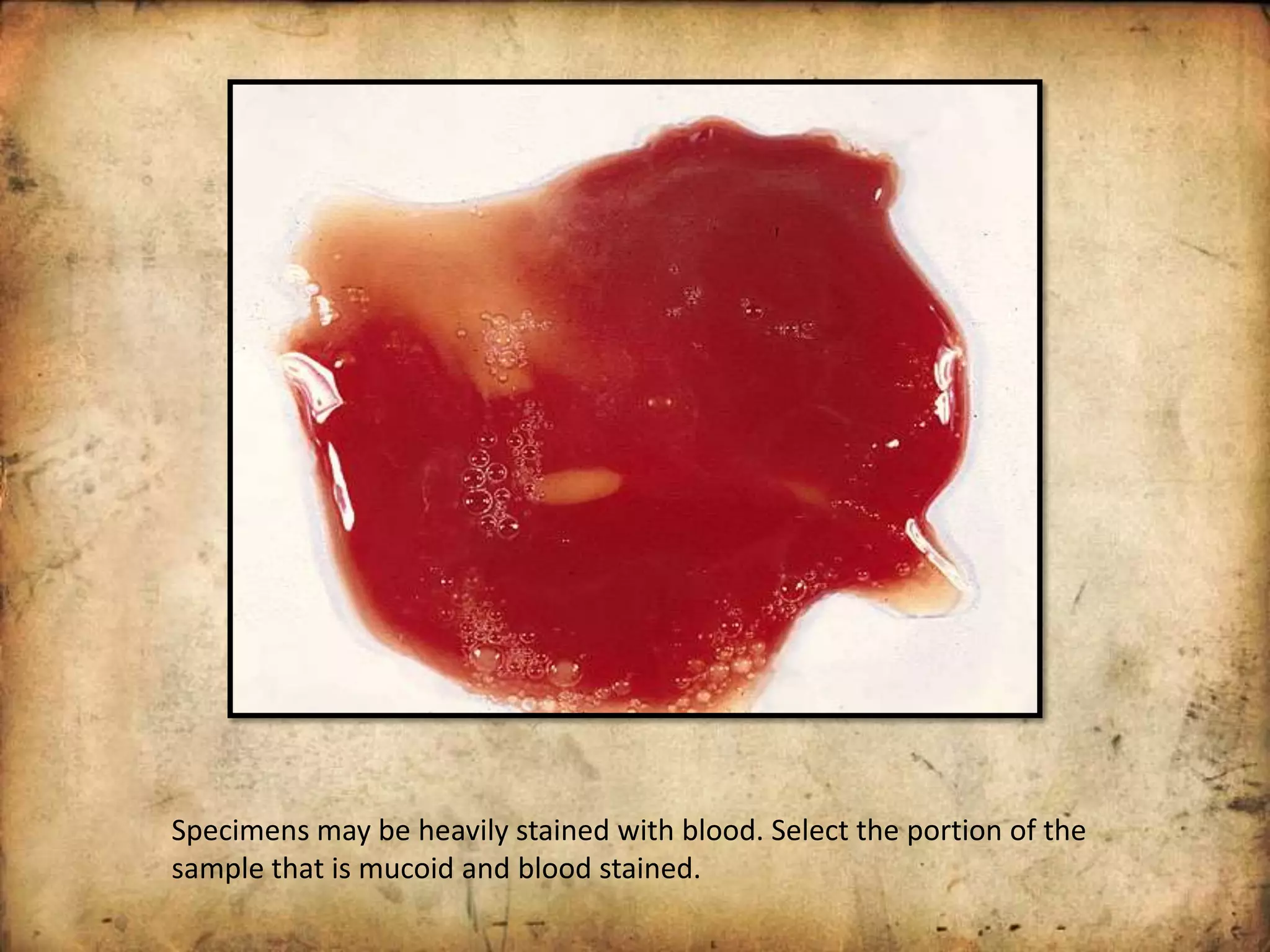 Use of Sputum sample for diagnosis of disease, interpretation ...