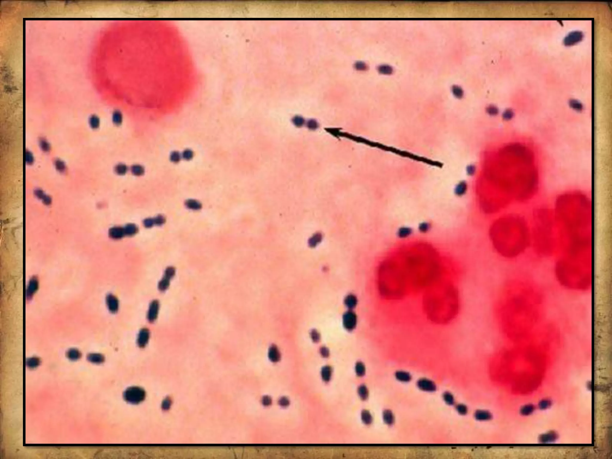 Use of Sputum sample for diagnosis of disease, interpretation ...