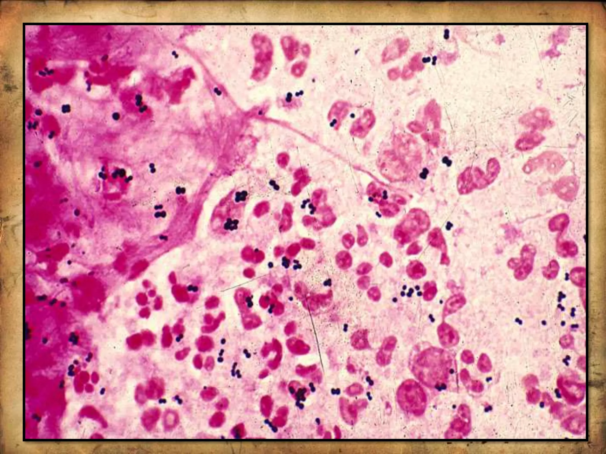 Use of Sputum sample for diagnosis of disease, interpretation ...