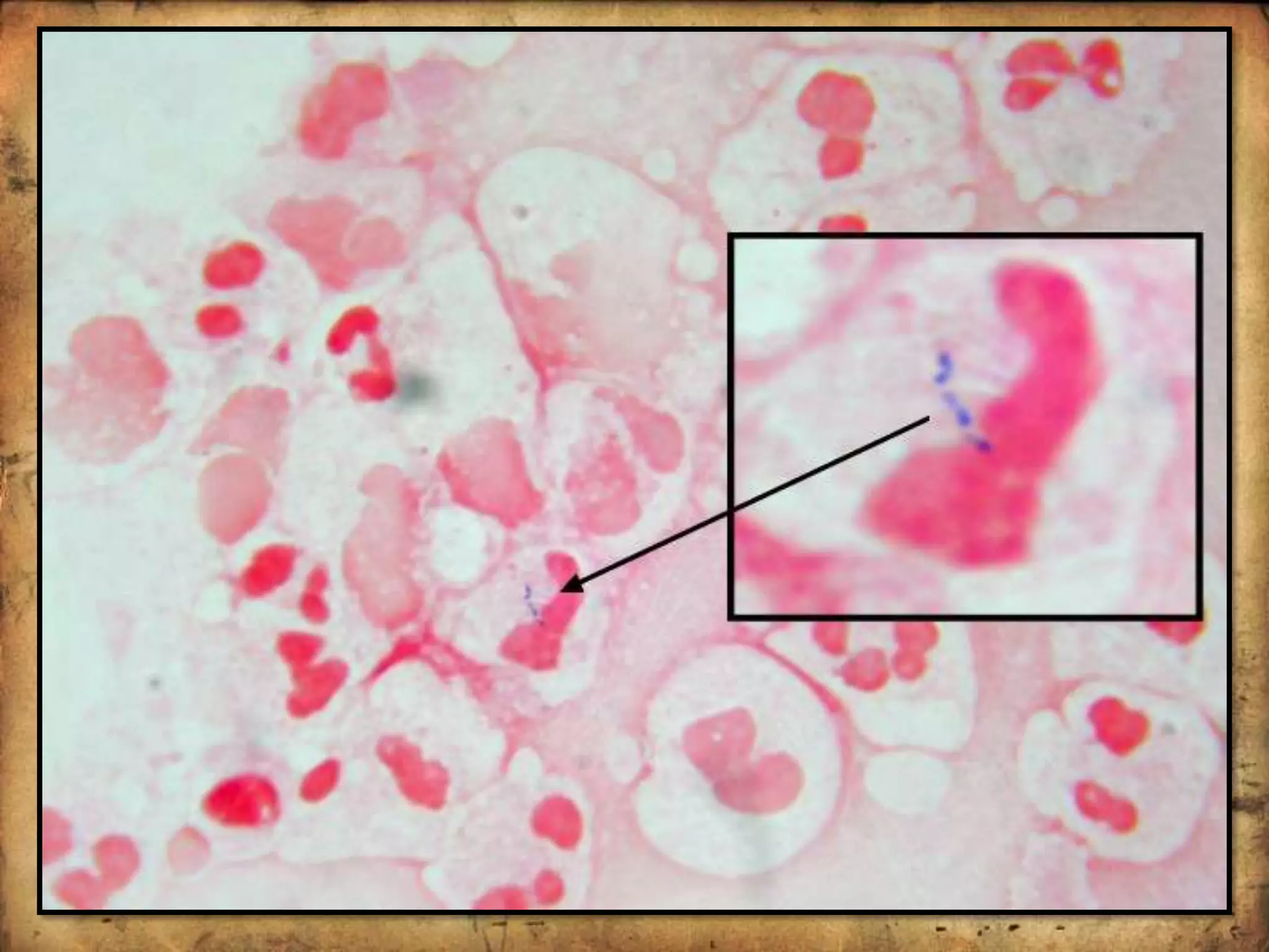 Use of Sputum sample for diagnosis of disease, interpretation ...