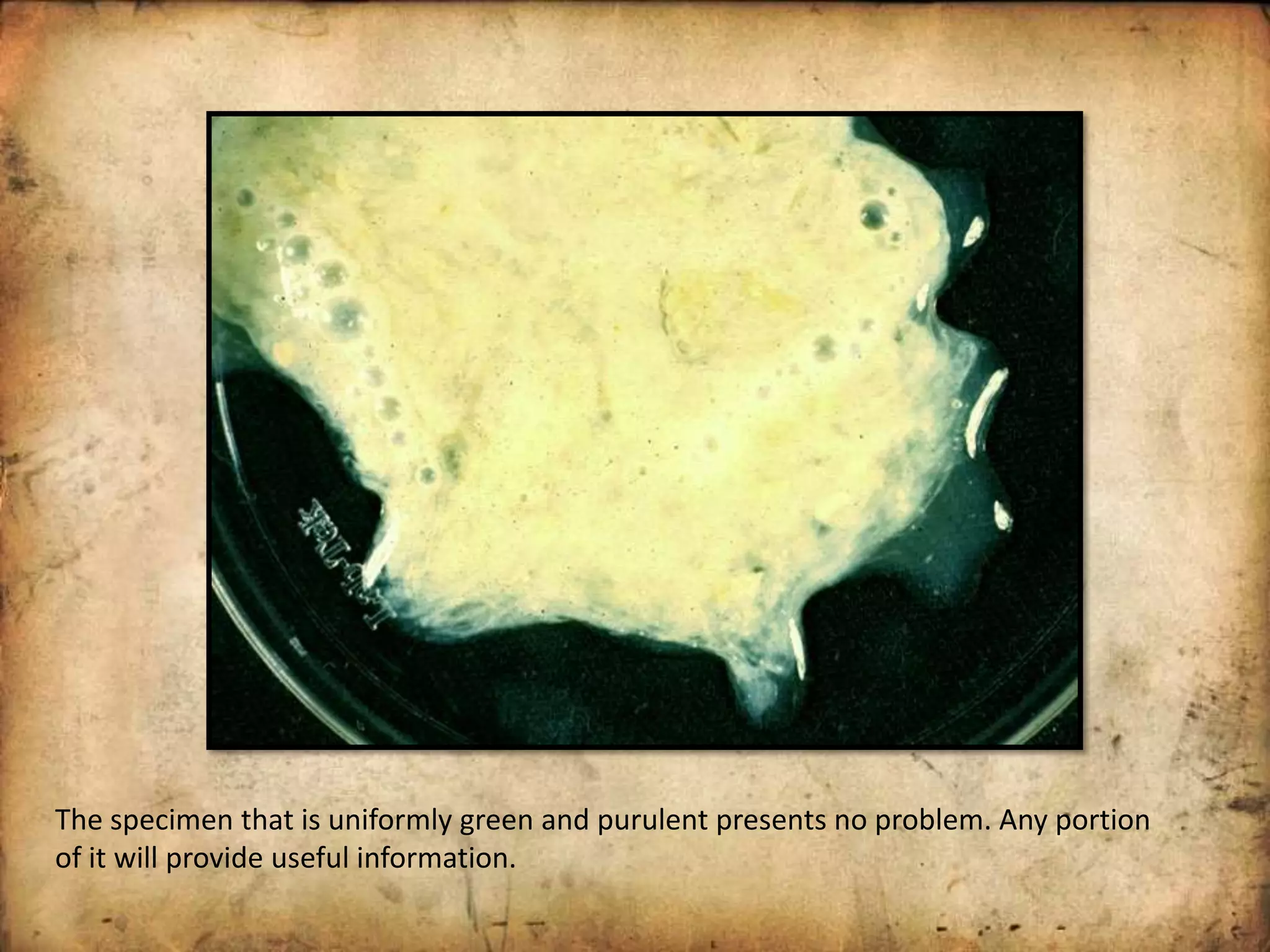 Use of Sputum sample for diagnosis of disease, interpretation ...