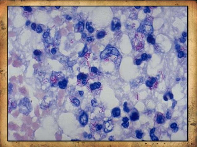 Use of Sputum sample for diagnosis of disease, interpretation ...