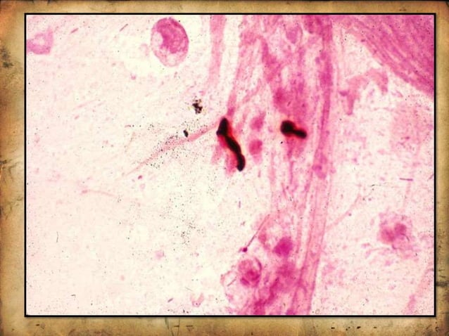 Use of Sputum sample for diagnosis of disease, interpretation ...