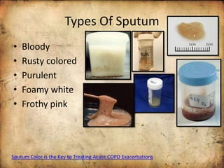 Sputum Sample Collection