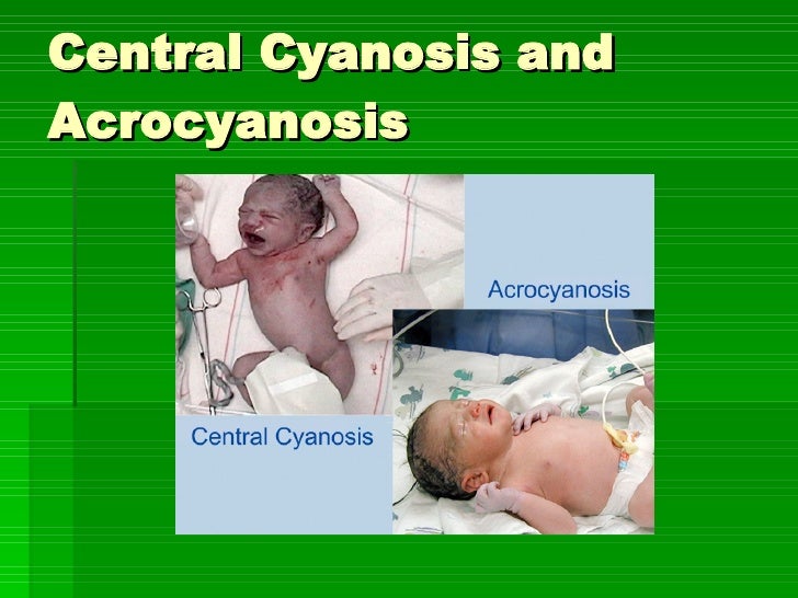 Newborn Resuscitation Program