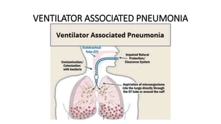 Non Resolving Pneumonia | PPTX
